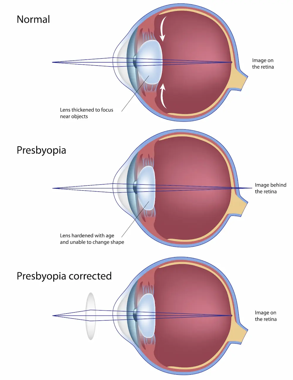 Vision Correction After 40: LASIK vs RLE in Los Angeles